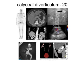 Congenital lesions and variants of renal system | PPT