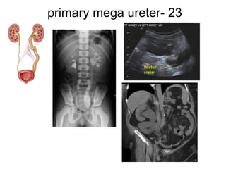 Congenital lesions and variants of renal system | PPT
