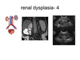 Congenital lesions and variants of renal system | PPT