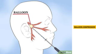 TRIGEMINAL NEURALGIA | PPT