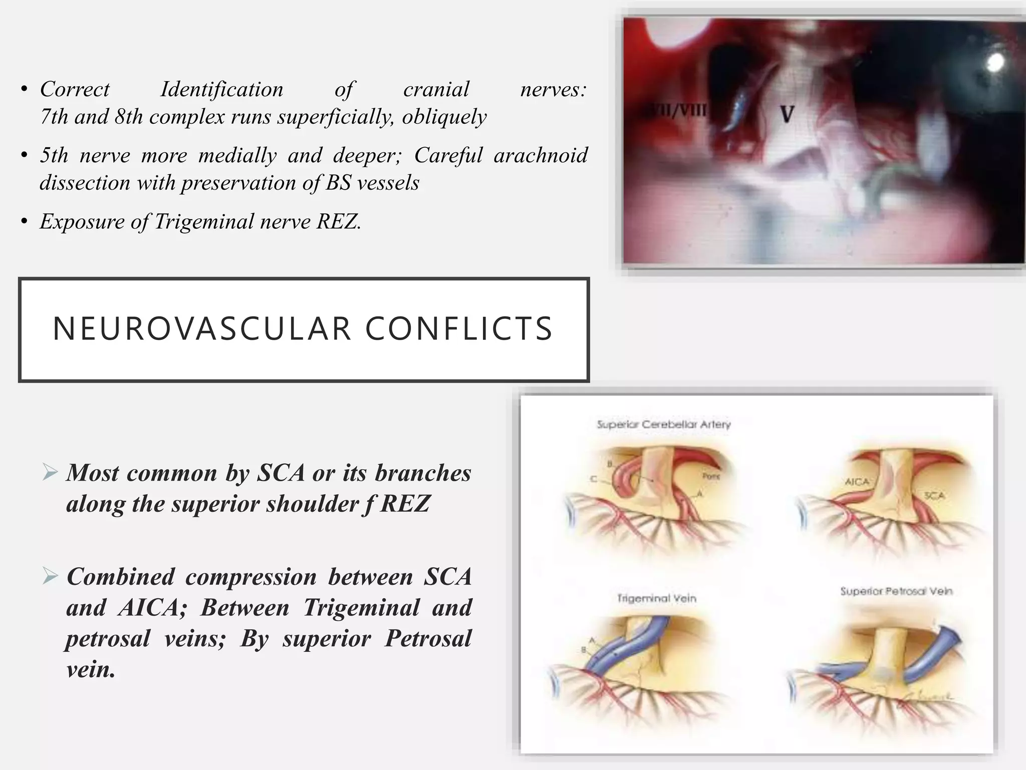 Trigeminal neuralgia | PPTX