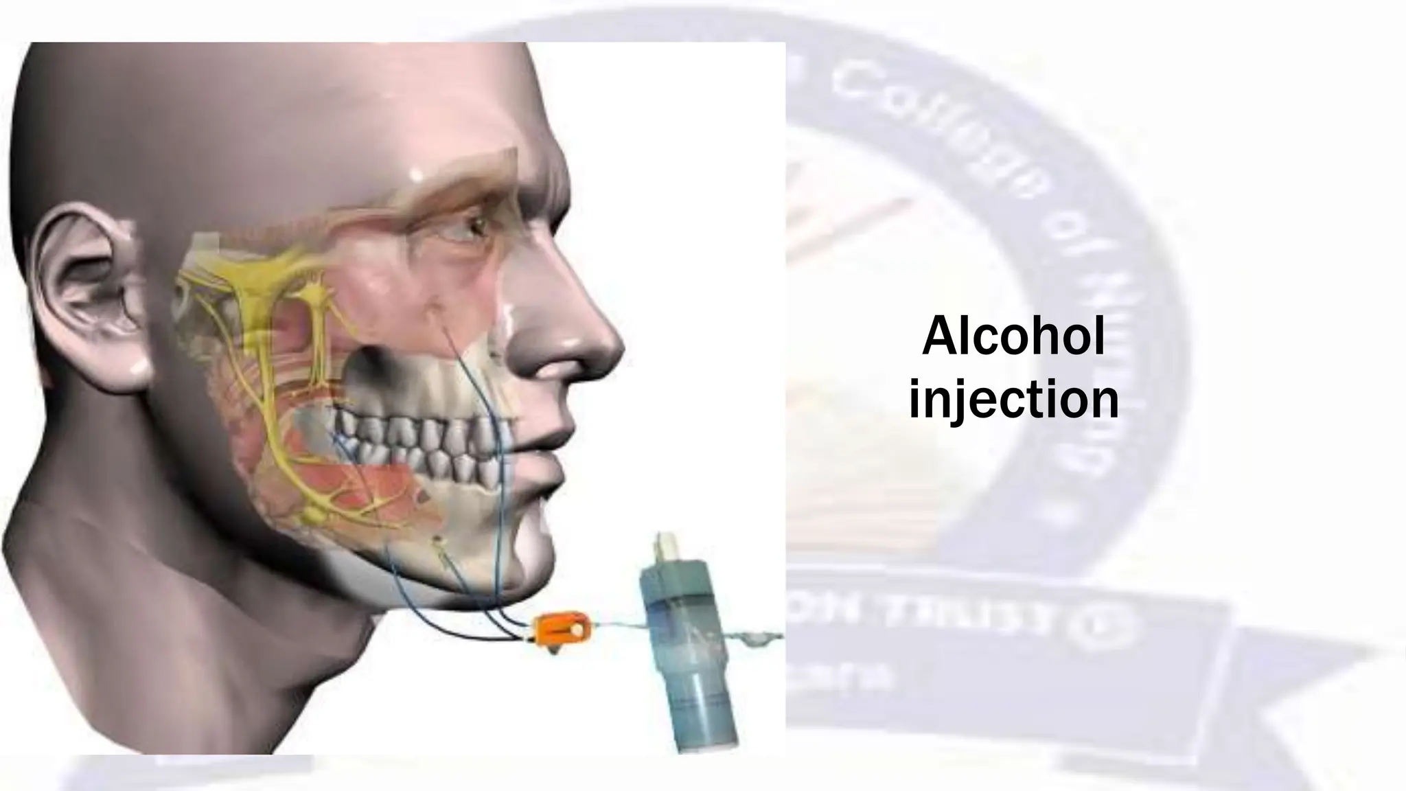 TGN.pptx trigeminal neuralgia achronic neurological disorder of sensory ...