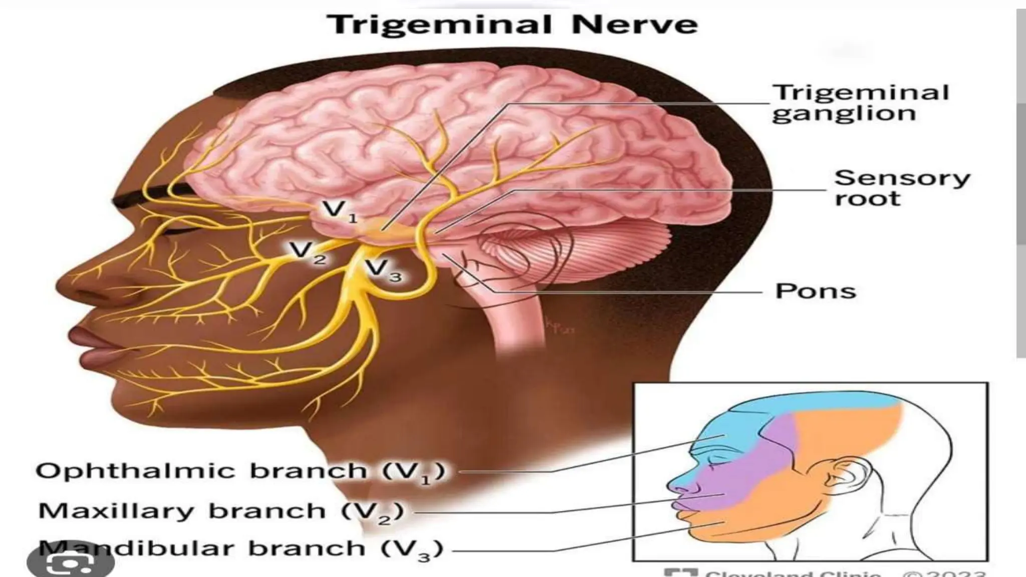 TGN.pptx trigeminal neuralgia achronic neurological disorder of sensory ...
