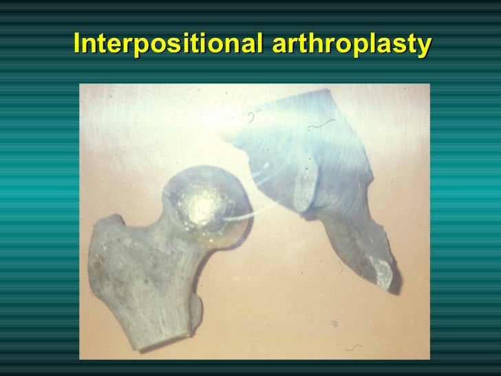 Total Hip Arthroplasty