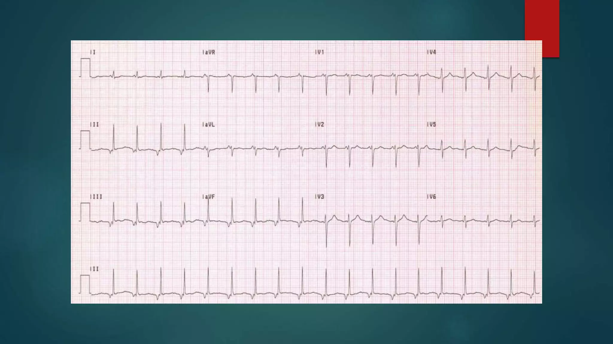 Tachyarrhythmia Management | PPTX