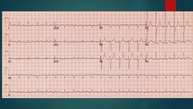 Tachyarrhythmia Management | PPTX | Heart and Cardiovascular Diseases ...