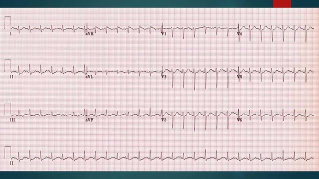 Tachyarrhythmia Management | PPTX | Heart and Cardiovascular Diseases ...
