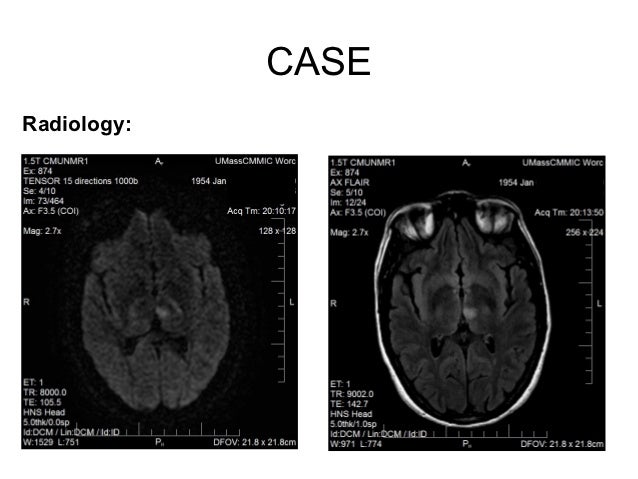 Thalamic infarction