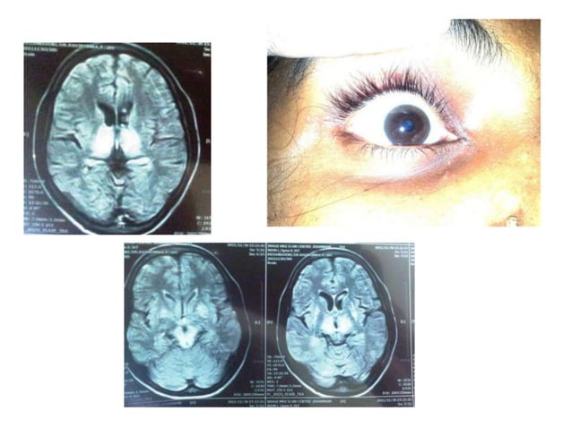 Thalamic lesions Radiology diagnose your self | PPTX | Brain and ...