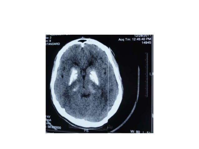 Thalamic lesions Radiology diagnose your self | PPTX | Brain and ...
