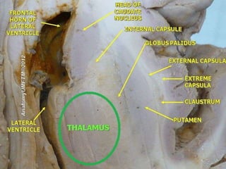 Thalamus, its functions and thalamic syndrome | PPTX