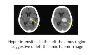 Physiology of thalamus | PPTX