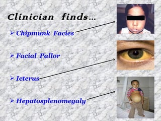 Thalassemia Avik | PPT