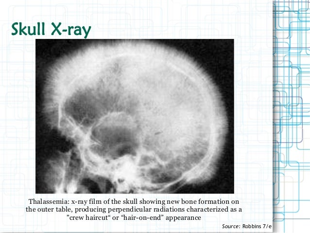 Thalassemias - Diagnosis and Management