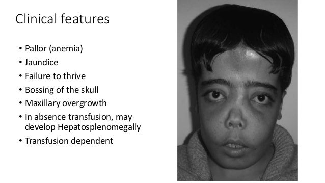 Thalassemia Facial Bone