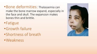 Thalassemia | PPTX