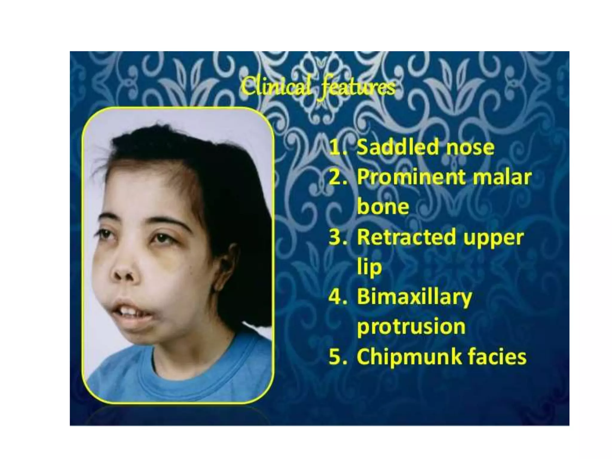 Thalassemia Ppt