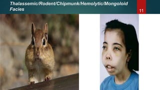 approach to a patient with htalassemia by Hari Sedai | PPT