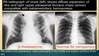 approach to a patient with htalassemia by Hari Sedai | PPT