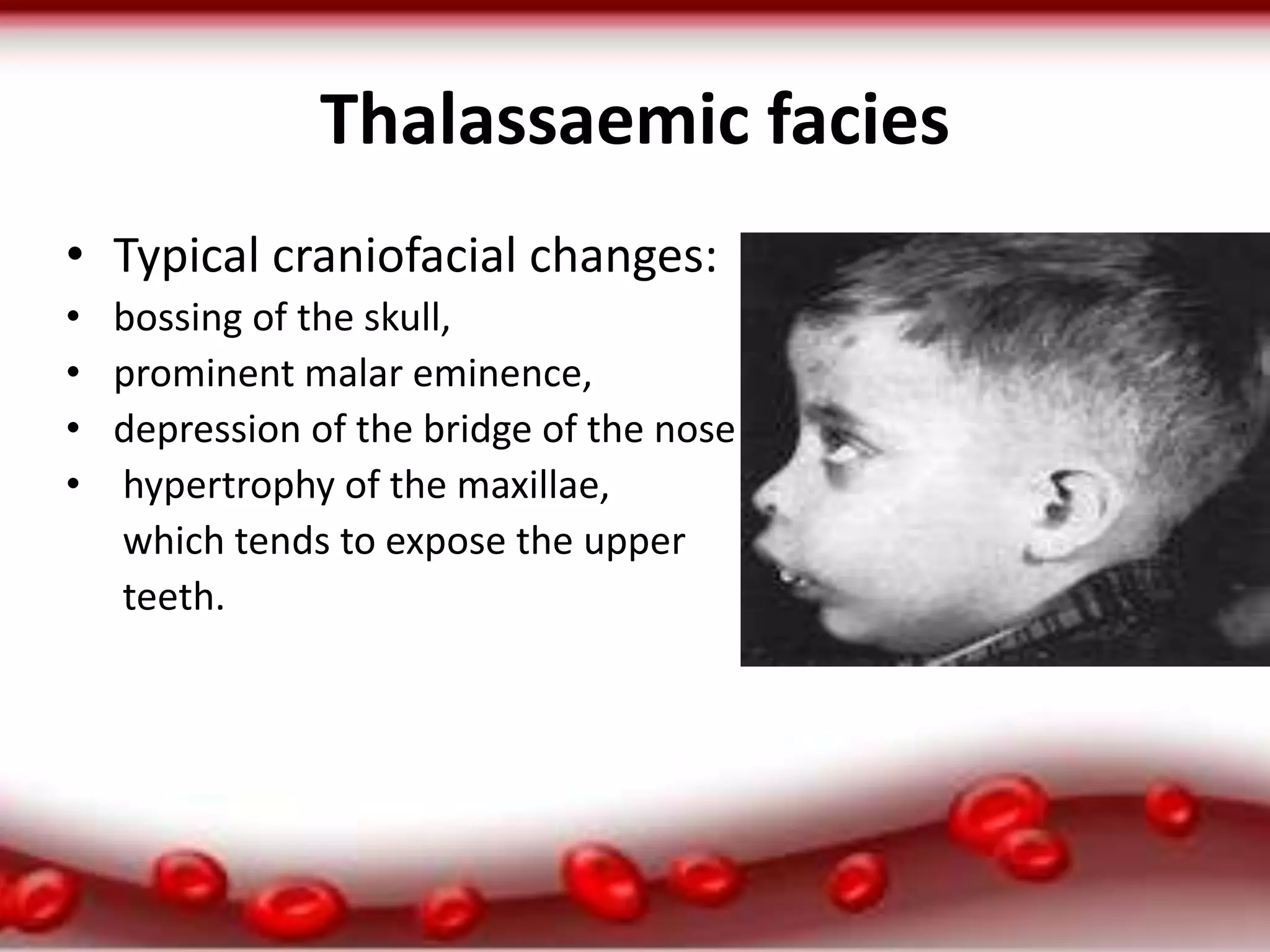 Thalassemia- Introduction and Diagnosis | PPTX