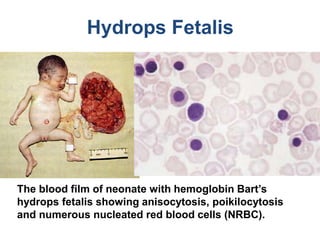 Thalassemias - A comprehensive review | PPT