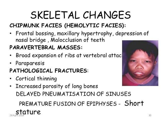 Thalassemia dr.k.v.giridhar