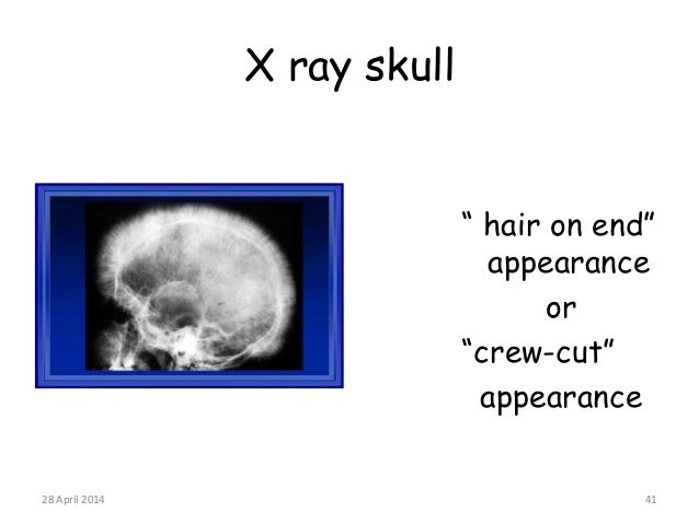 Thalassemia dr.k.v.giridhar