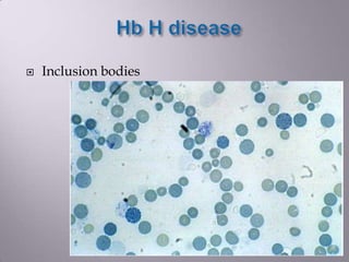 Hemoglobin Inclusion Bodies