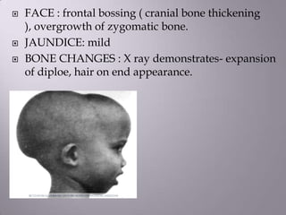 Frontal Bossing Thalassemia