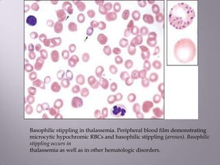 Basophilic Stippling Thalassemia
