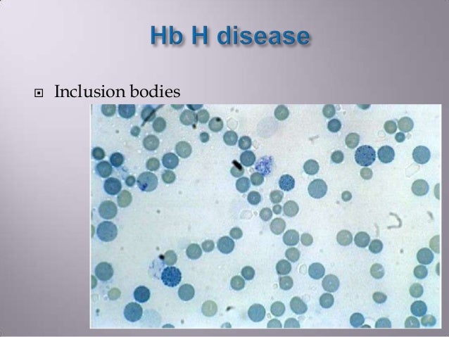 Thalassemia.by dr narmada