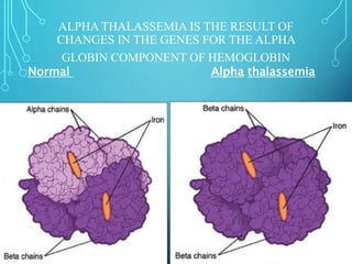 Thalassemia+%26+Sickle+Cell+++Anaemia%5B90%5D.ppt