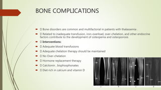 Thalassemia complications | PPTX
