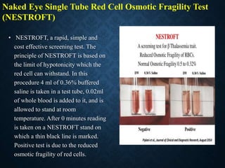 Thalassemia gs | PPT