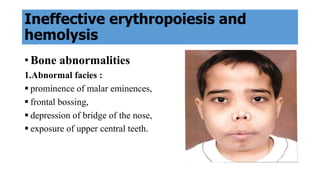 Frontal Bossing Thalassemia