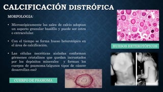 calcificacion patologica | PPTX