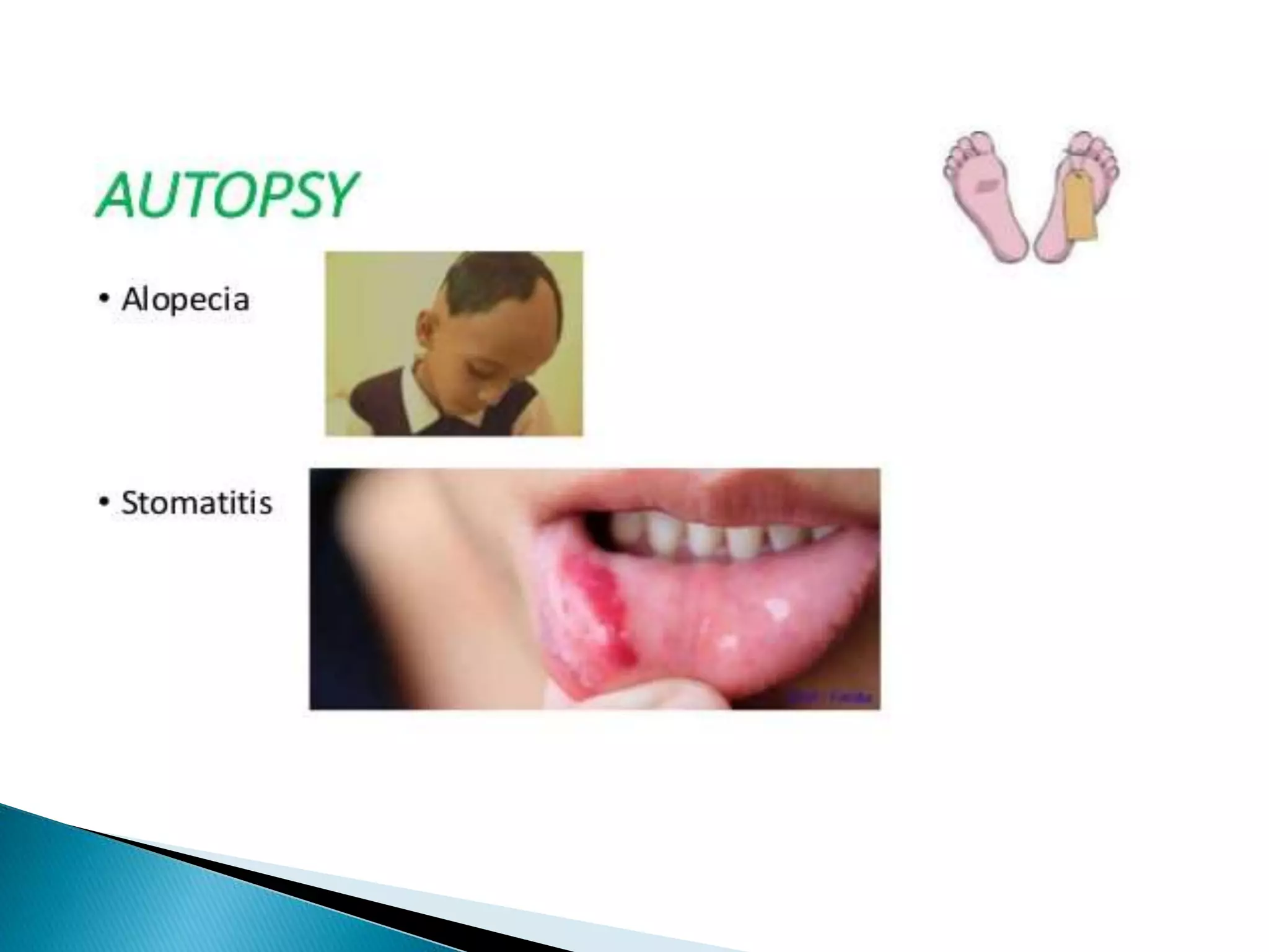 Thallium toxicity | PPTX