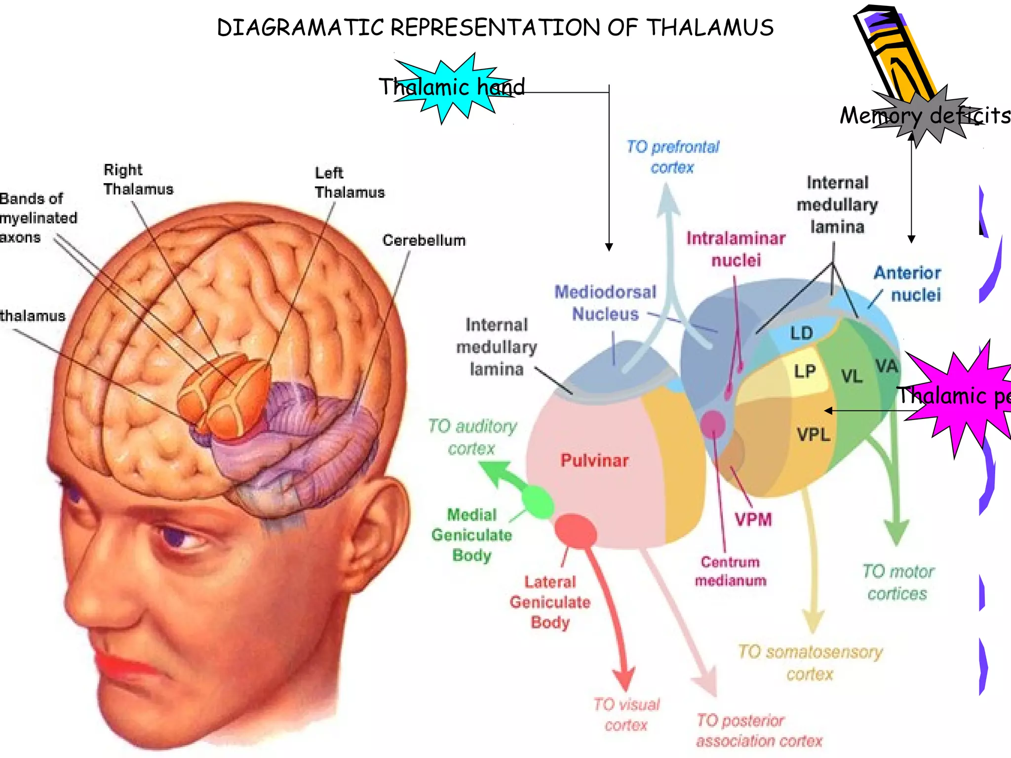 Thalmic stroke | PPT