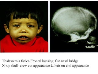 thalassemia and sickle cell disease | PPT