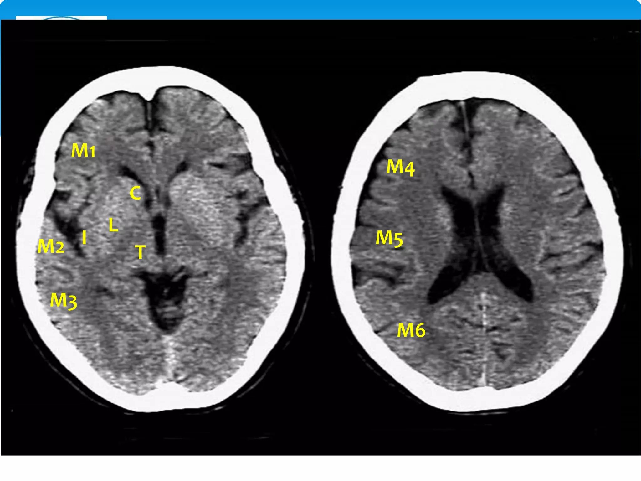 Thang điểm ASPECT | PDF