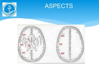 Thang điểm ASPECT | PDF