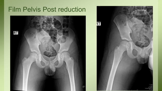 Tharinee anterior-hip-dislocation | PPTX
