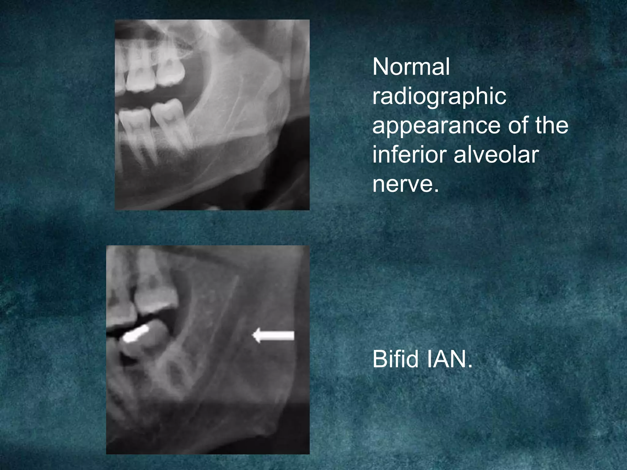 Mandibular nerve | PPTX