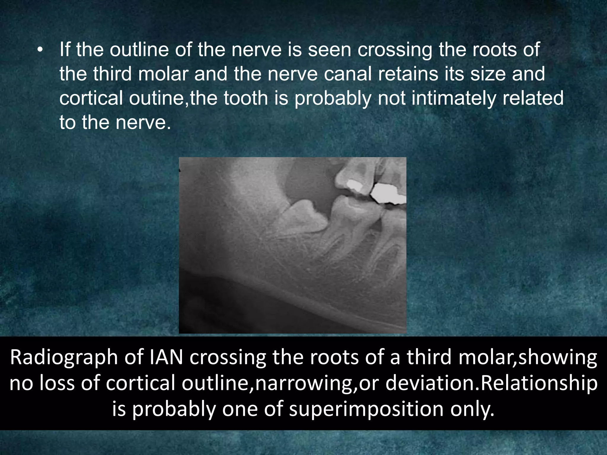 Mandibular nerve | PPTX
