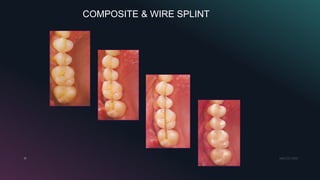 Periodontal splinting | PPTX