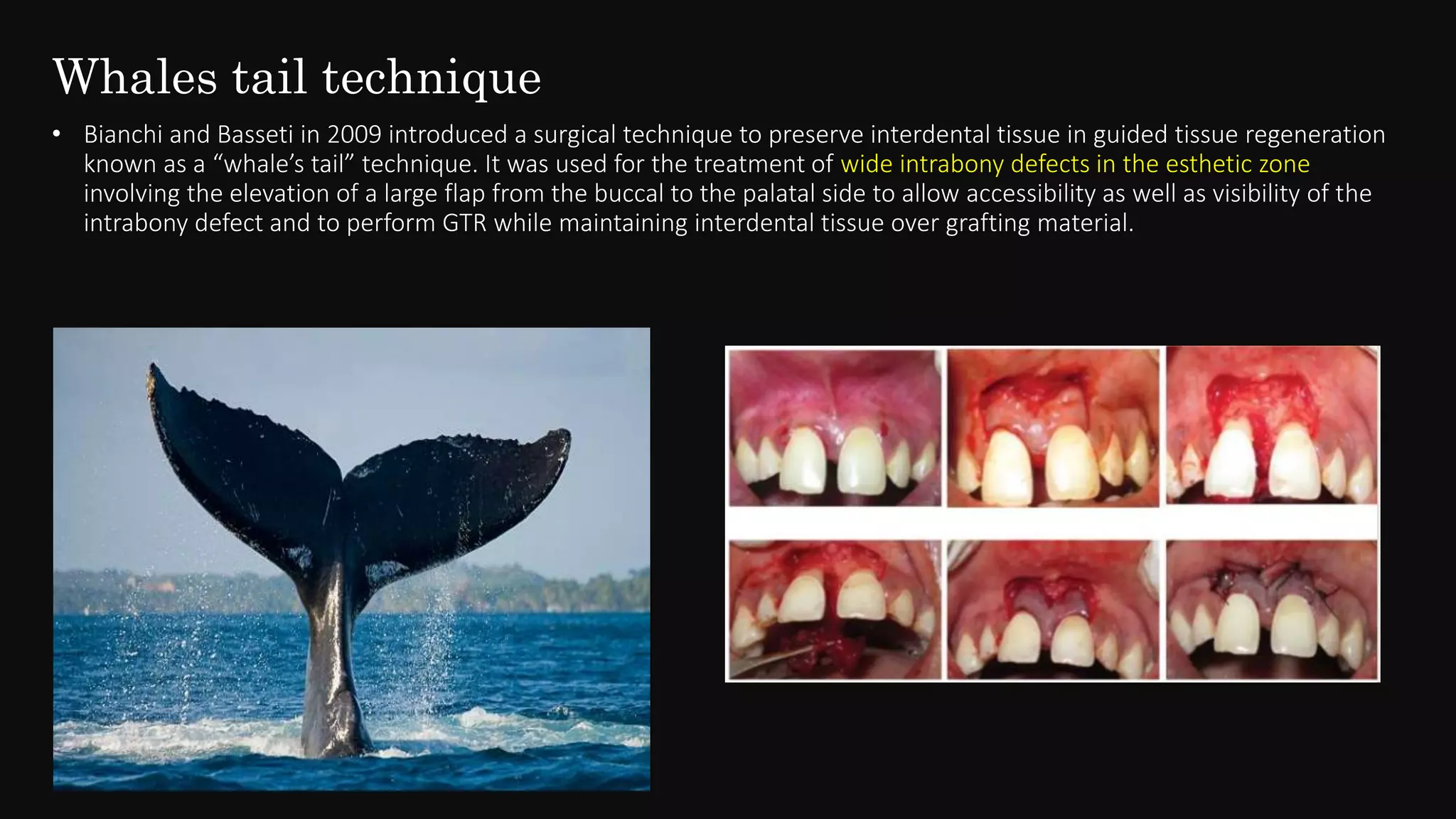 Minimally invasive periodontal surgery | PPTX