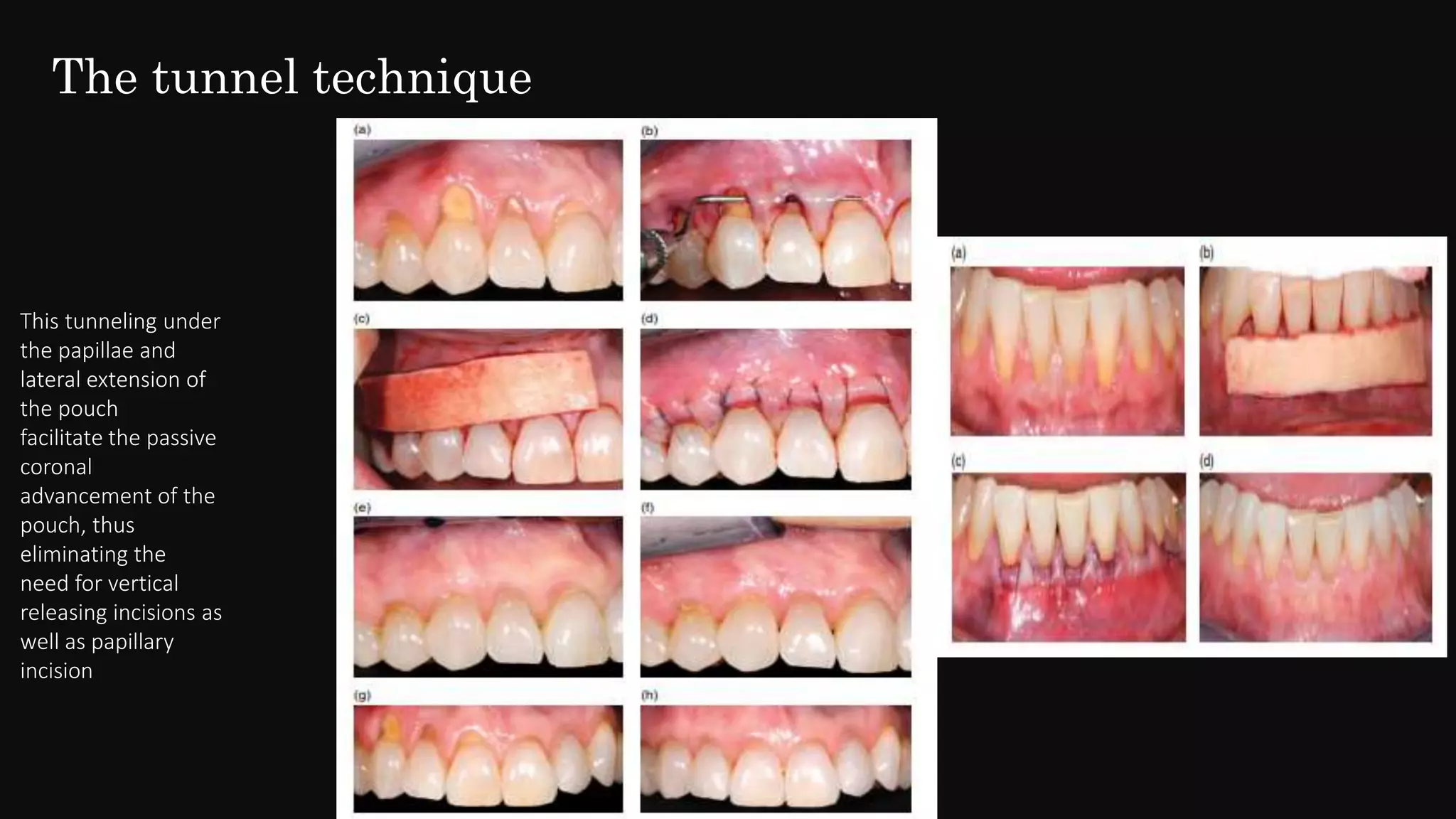 Minimally invasive periodontal surgery | PPTX