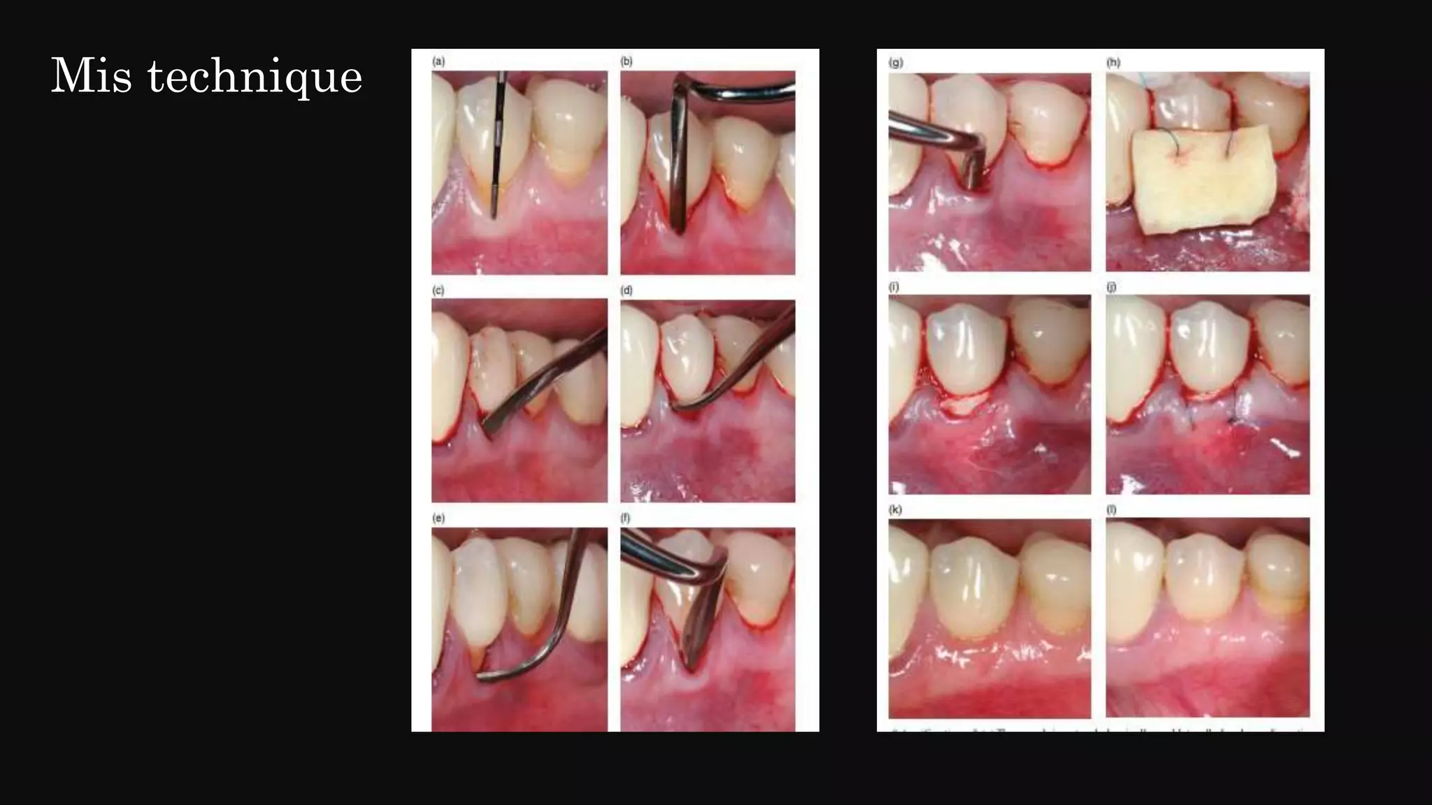 Minimally invasive periodontal surgery | PPTX