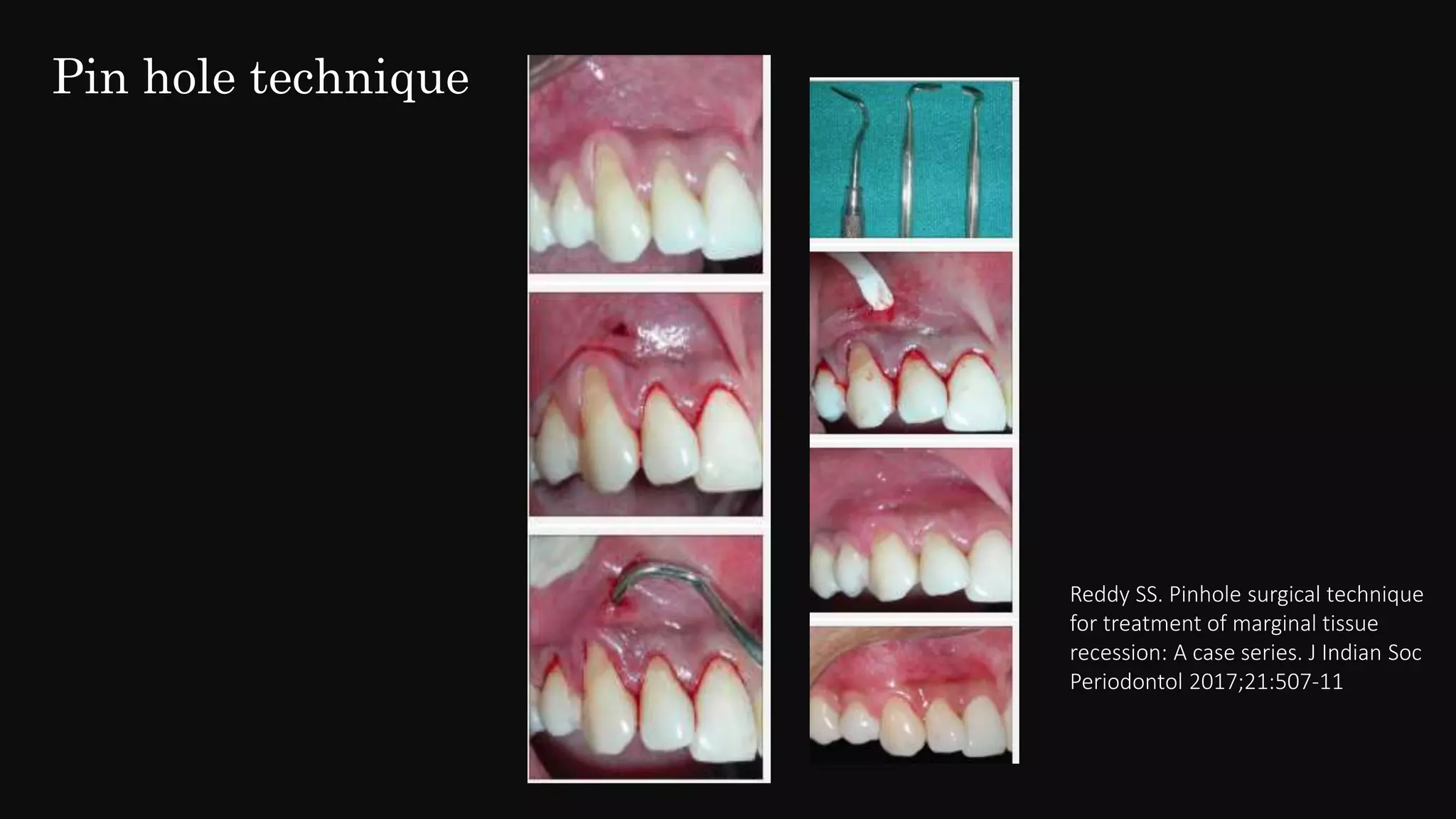 Minimally invasive periodontal surgery | PPTX