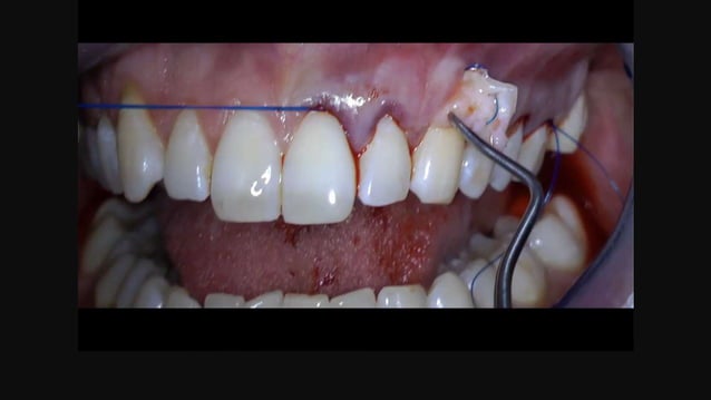 Minimally invasive periodontal surgery
